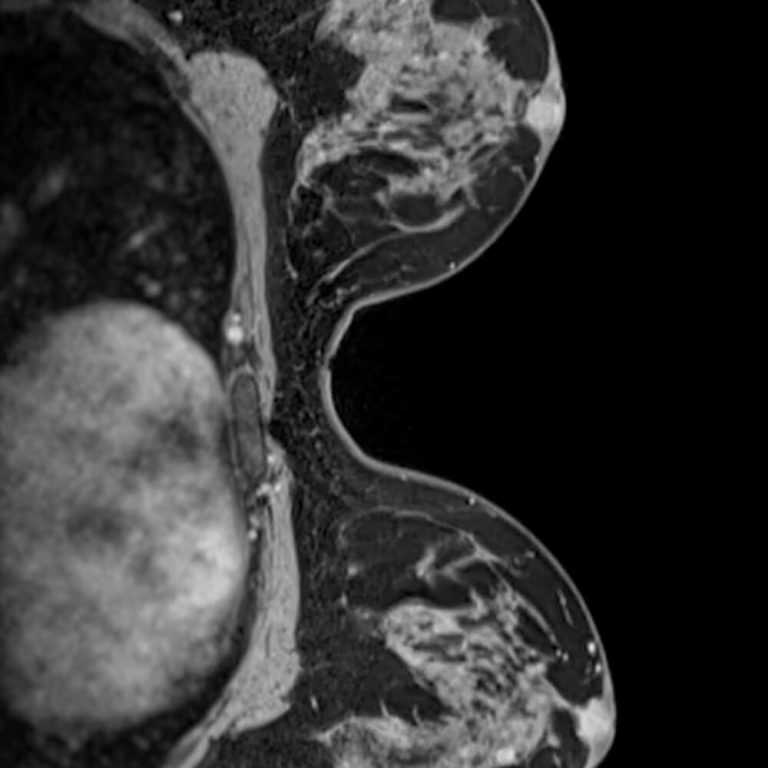 Breast MRI Screening - Whole Body Mri